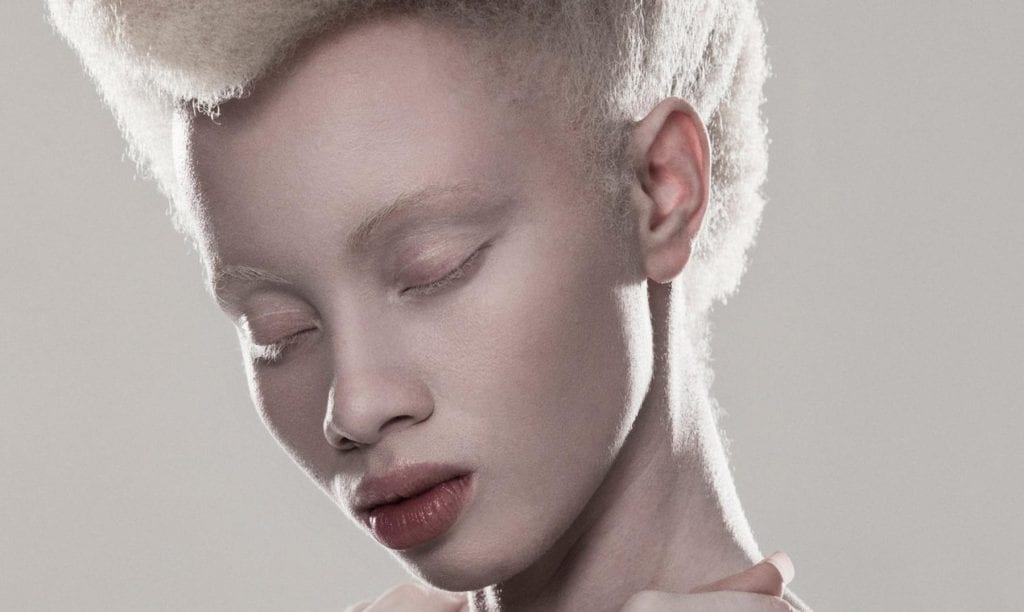 Albinos et fière 5 manières d'impacter dans notre société